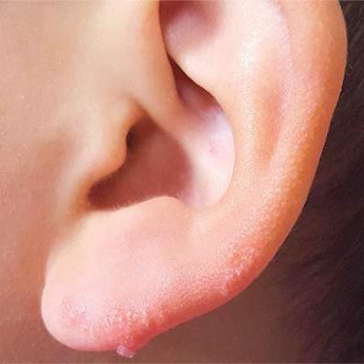 Ear “Wart” Prompts Unkind Comments | Clinician Reviews