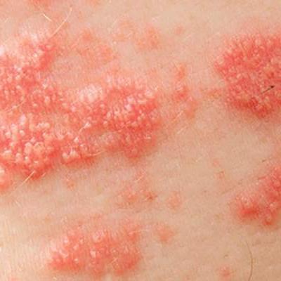 Shingles Vaccine Protection Lasted 5-6 Years in Autoimmune Disease ...
