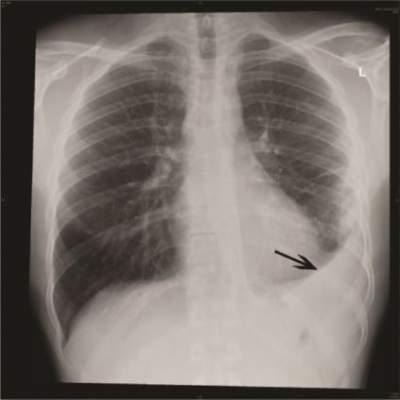 Hospitalization for pneumonia raises CVD risk | MDedge Emergency Medicine