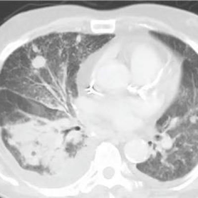 Febrile, Immunocompromised Man With Rash | Clinician Reviews
