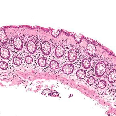 AGA publishes microscopic colitis guideline | MDedge Family Medicine