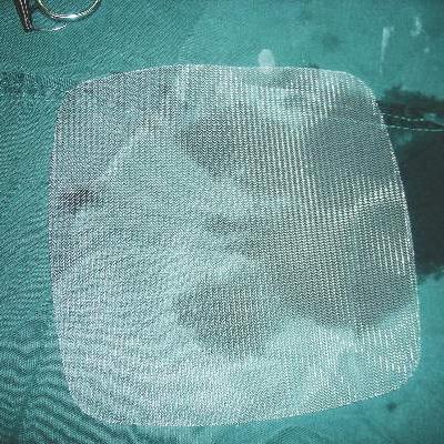 Light mesh doesn’t outweigh heavy mesh for hernia repair | MDedge Surgery