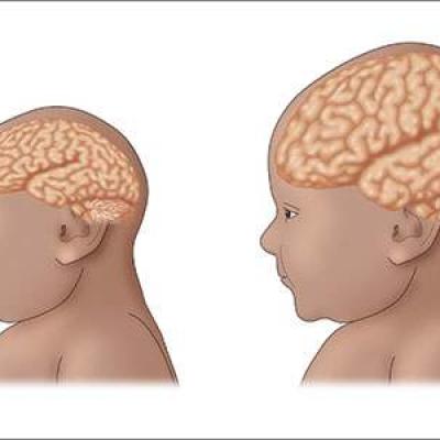 Small Head Syndrome