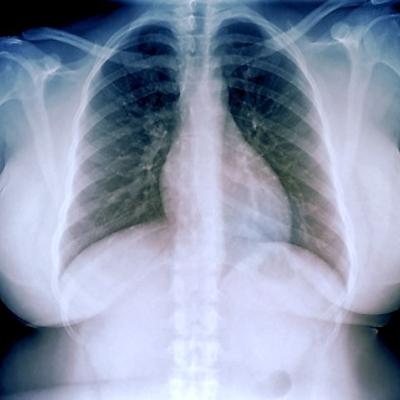 Mild shortness of breath | Obesity Challenge Center