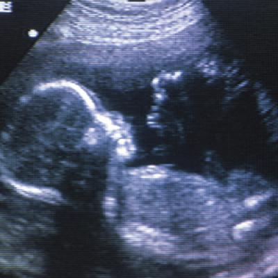 Nonstress test and maximal vertical pocket vs the biophysical profile ...