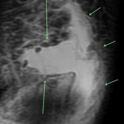 Fat Fracture: A Rare Cause of Anterior and Medial Knee Pain in a ...