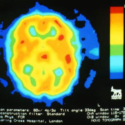Woman with throbbing unilateral headache | Migraine Challenge Center