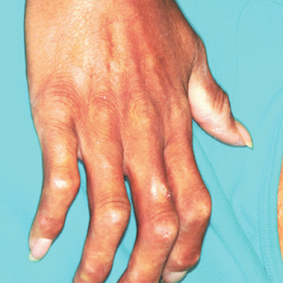 Skin Changes on Hands Lead to Daily Living Problems | Clinician Reviews