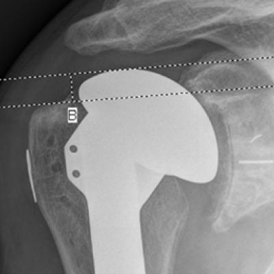 Radiographic Study of Humeral Stem in Shoulder Arthroplasty After ...