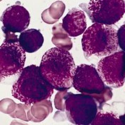 Genes may be targets for AML therapy | MDedge Hematology and Oncology