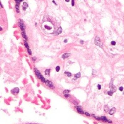 Study: CMV doesn’t lower risk of relapse, death | MDedge Hematology and ...