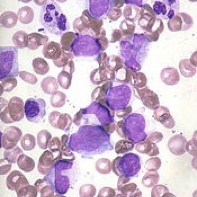 Method can identify CTCL quickly, study suggests | MDedge Hematology ...