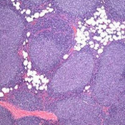 Characterizing FL transformation, progression | MDedge Hematology and ...