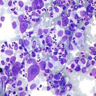 CHMP recommends approval for generic carmustine | MDedge Hematology and ...