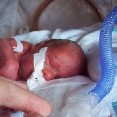 Platelet transfusions do not reduce IVH risk in VLBW infants | MDedge ...