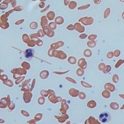 Models provide new understanding of sickle cell disease | MDedge ...