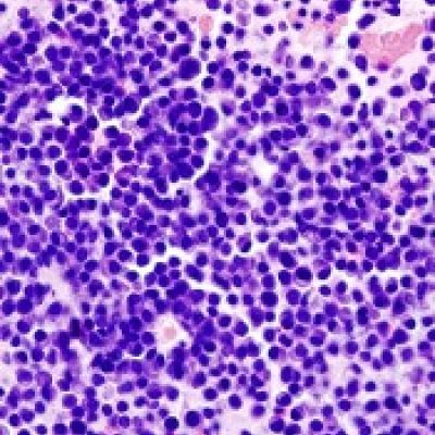 Selinexor receives fast track designation for MM | MDedge Hematology ...