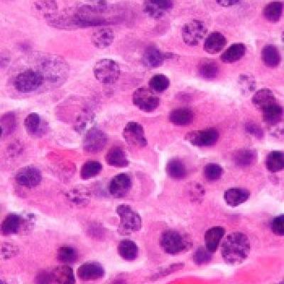 Antibody recognizes human plasma cells | MDedge Hematology and Oncology