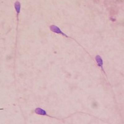 How lymphoma affects male fertility | MDedge Hematology and Oncology