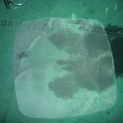 Lightweight mesh reduces erosion risk after sacrocolpopexy | MDedge ObGyn