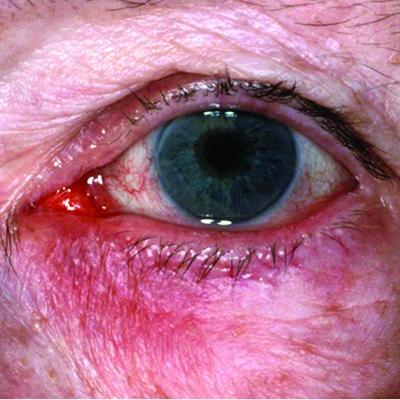Ocular rosacea remains a stubborn foe | MDedge Internal Medicine
