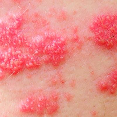Shingles vaccine deemed effective in people with autoimmune disease ...