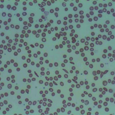 Low plasma sodium levels can predict complications in acute painful ...